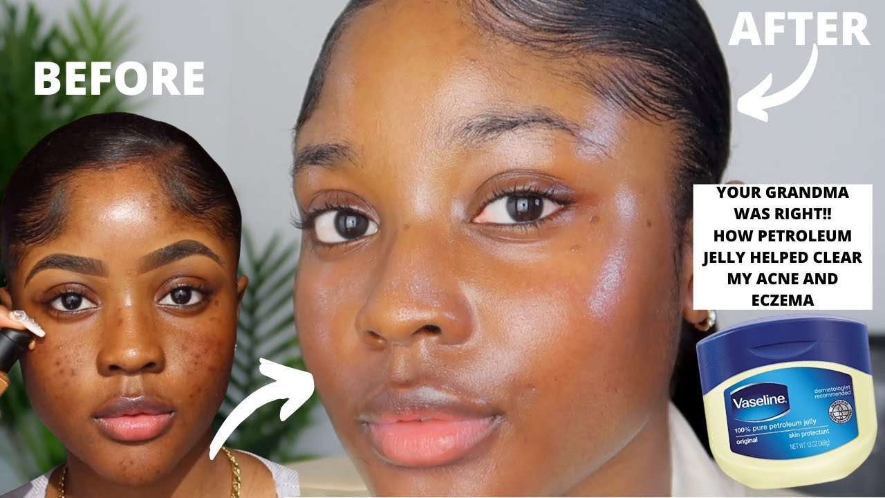 Haarlemensis & Vaseline: Proven Results for Even Skin Tone (Before ...